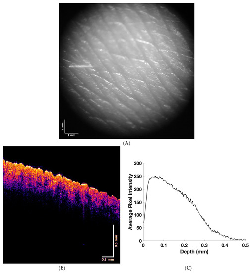 Melanin Stacking Differences in Pigmented and Non-Pigmented Melanomas ...