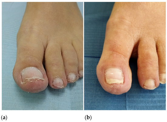 Hallux Partial Necrosis Associated with Antiphospholipid Syndrome: The ...