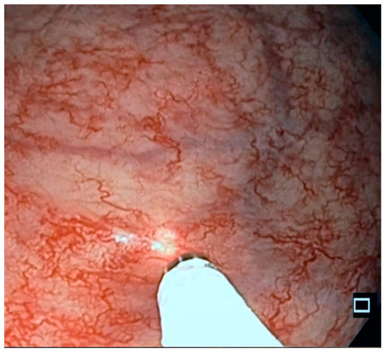 Diode Laser Therapy for Radiation-Induced Vascular Ectasia: Long-Term ...