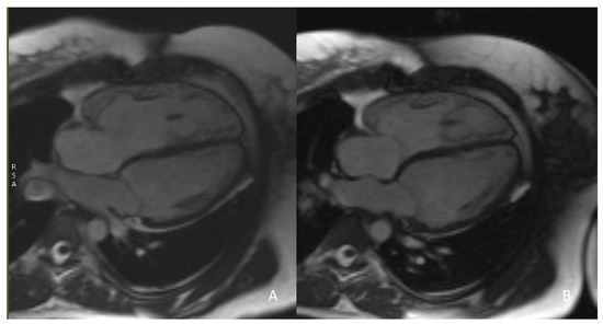 CMR and Percutaneous Treatment of Pulmonary Regurgitation: Outreach the ...