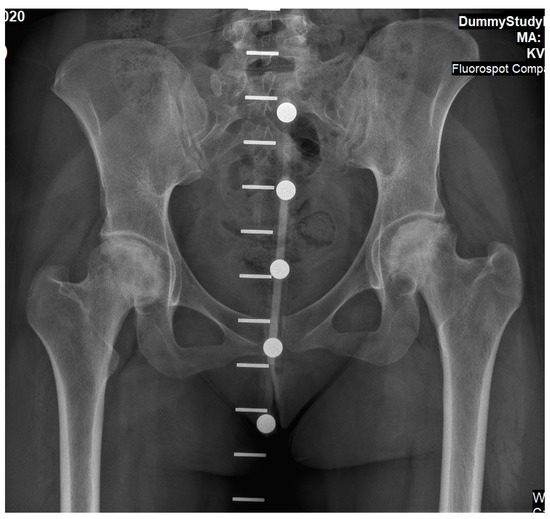 Simultaneous Bilateral Femoral Osteonecrosis in Gaucher Disease