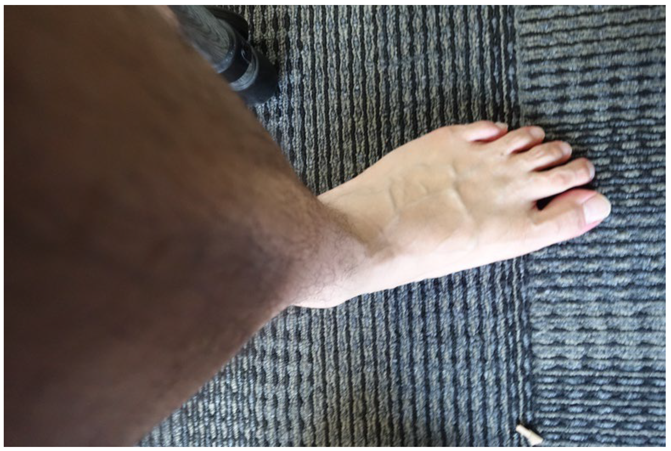 Life | Free Full-Text | Development of Hallux Valgus Classification ...