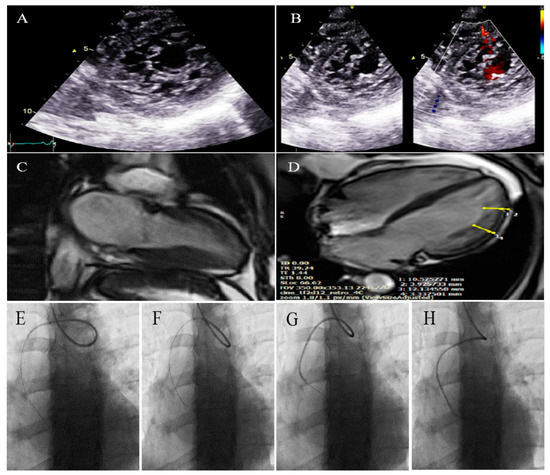 Non-Compaction Ventricle and Associated Cardiovascular and Non ...