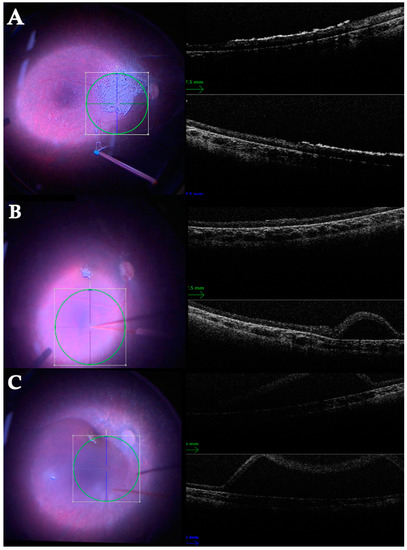 Life Free Full Text Pars Plana Vitrectomy In Inherited Retinal
