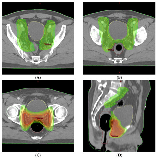 Early Detection of Secondary Bladder Urothelial Carcinoma and ...