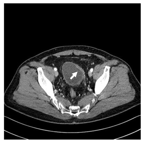 Early Detection of Secondary Bladder Urothelial Carcinoma and ...