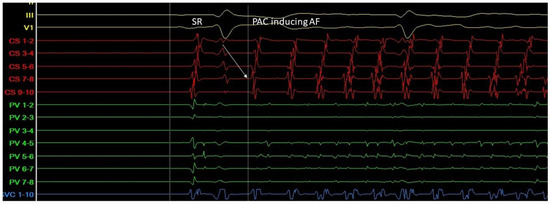 Mechanisms of Atrial Fibrillation: How Our Knowledge Affects Clinical Practice