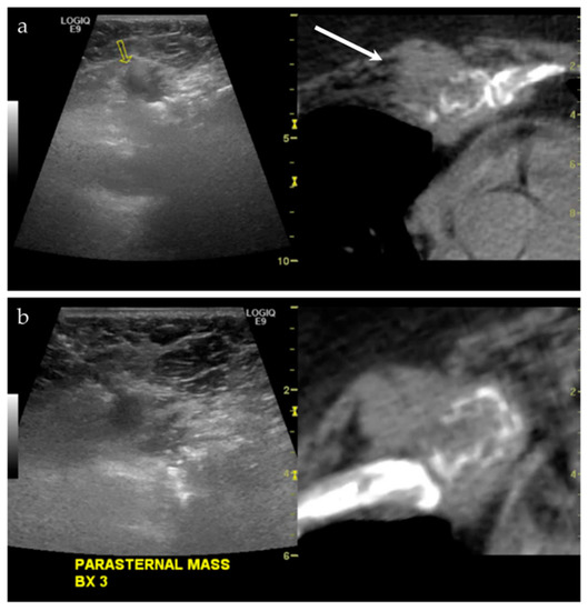 Ultrasound Fusion: Applications in Musculoskeletal Imaging