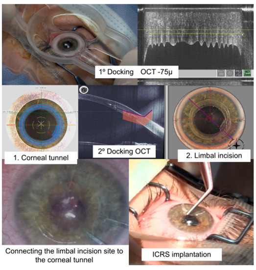 ByLimb: Development of a New Technique to Implant Intracorneal Ring ...