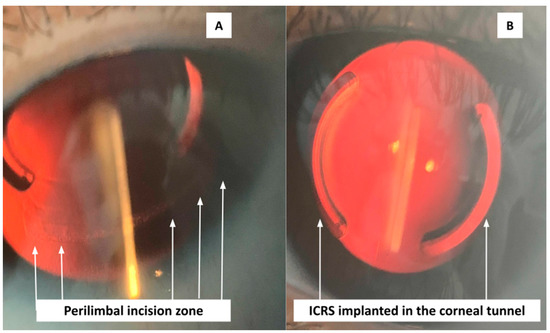 ByLimb: Development of a New Technique to Implant Intracorneal Ring ...