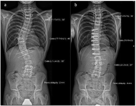 Life | Free Full-Text | Surgical Treatment of Spinal Deformities in ...