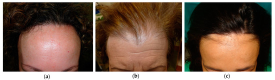 Frontal Fibrosing Alopecia: An Observational Single-Center Study of 306 ...