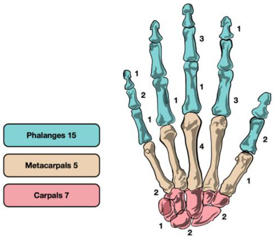 Osteoid Osteoma of the Hand: Surgical Treatment versus CT-Guided ...