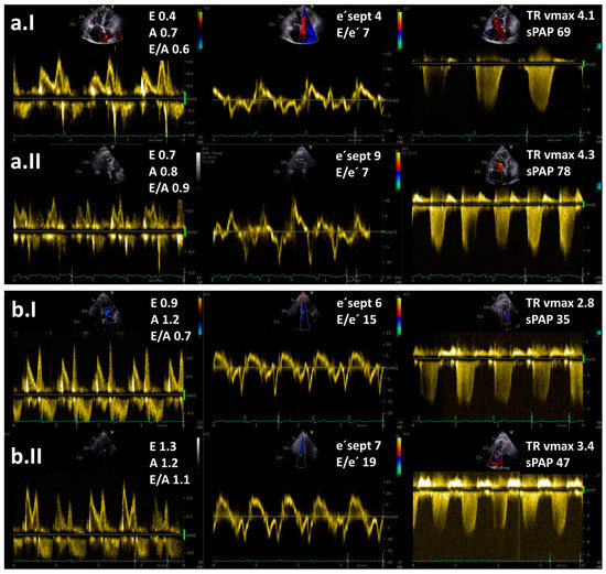 Role of Exercise Stress Echocardiography in Pulmonary Hypertension