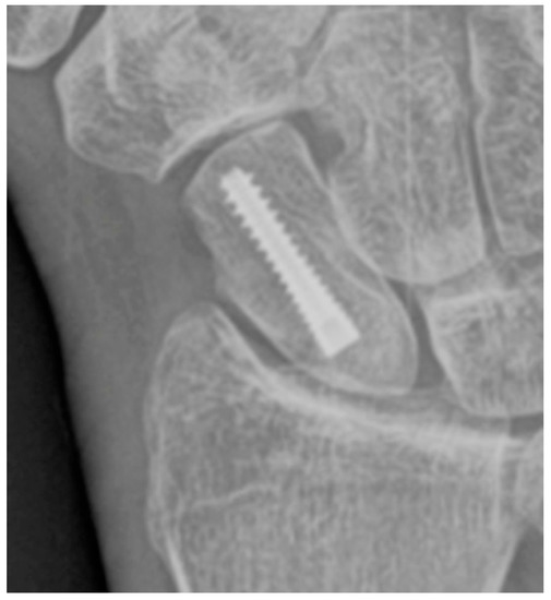 Life | Free Full-Text | Imaging Diagnosis and Management of Carpal ...