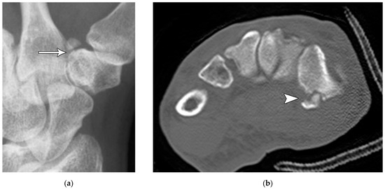 Imaging Diagnosis and Management of Carpal Trauma and Instability—An ...