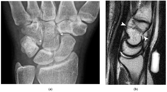 Imaging Diagnosis and Management of Carpal Trauma and Instability—An ...