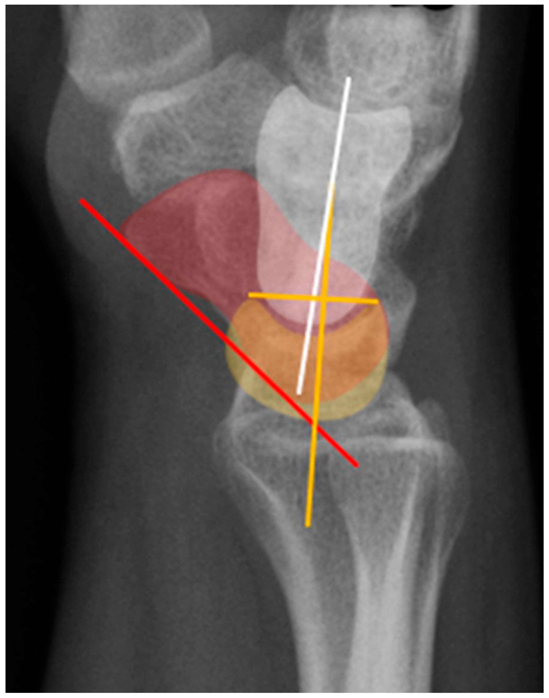 Life Free Full Text Imaging Diagnosis And Management Of Carpal