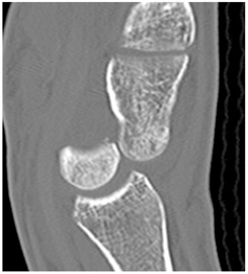 Life | Free Full-Text | Imaging Diagnosis and Management of Carpal ...