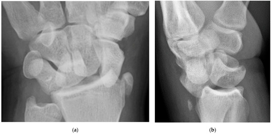 Life | Free Full-Text | Imaging Diagnosis and Management of Carpal ...