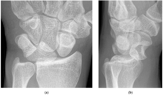 Life | Free Full-Text | Imaging Diagnosis and Management of Carpal ...