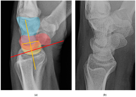 Life | Free Full-Text | Imaging Diagnosis and Management of Carpal ...