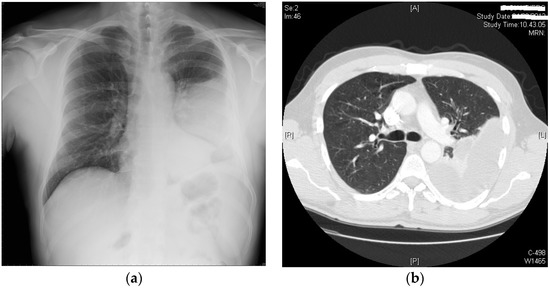 A Strange Case of Traumatic Pleural Effusion: Pleural Empyema Due to ...