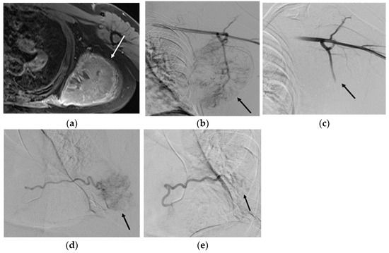 Transarterial Embolization and Percutaneous Ablation of Primary and ...