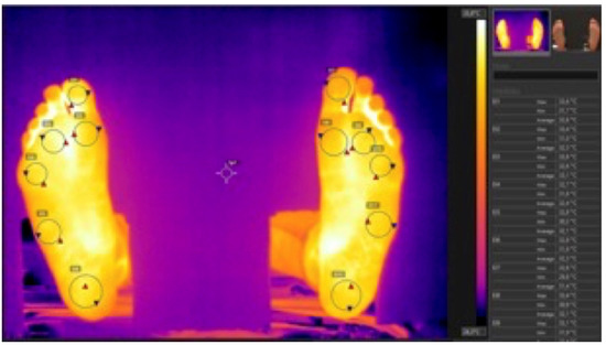 Thermal Differences in the Plantar Surface Skin of the Foot after Using ...