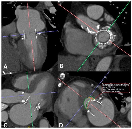 Contemporary Review of Transcatheter Mitral Valve Interventions for ...