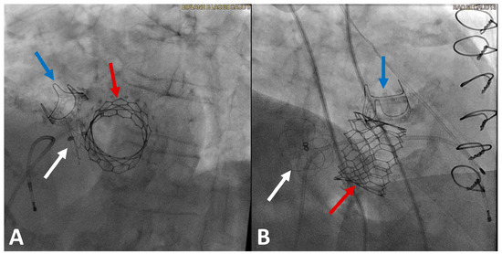 Contemporary Review of Transcatheter Mitral Valve Interventions for ...
