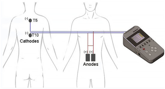 Transcutaneous Spinal Cord Stimulation Facilitates Respiratory ...