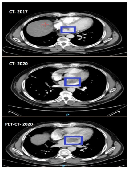Radiotherapy-Induced Atrial Myxoma: A Case Report and Literature Review