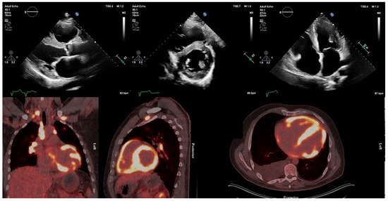 The Role of Echocardiography in the Contemporary Diagnosis and Prognosis of Cardiac Sarcoidosis ...