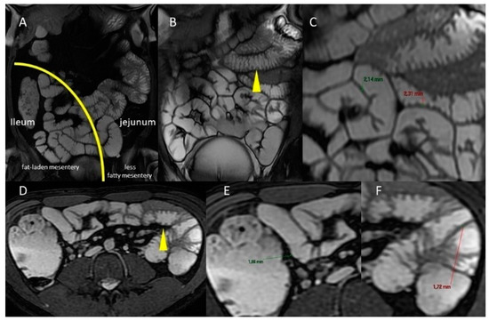 Small Bowel Imaging from Stepchild of Roentgenology to MR Enterography ...