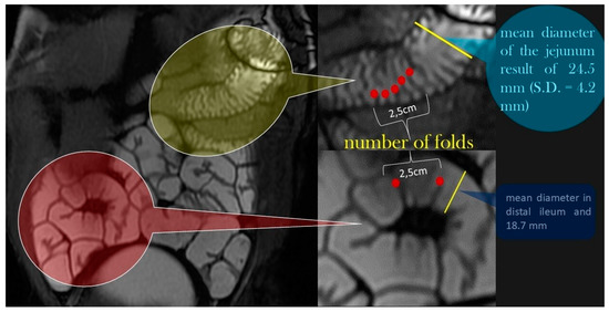 Small Bowel Imaging from Stepchild of Roentgenology to MR Enterography ...