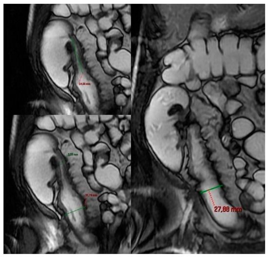 Small Bowel Imaging from Stepchild of Roentgenology to MR Enterography ...