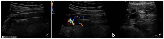 Assessment of Ileal Crohn’s Disease Activity by Gastrointestinal ...