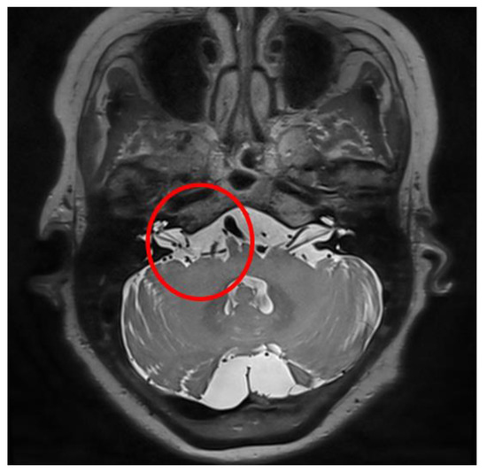 Management of Cerebrospinal Fluid Leakage after Microvascular ...