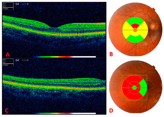 Visual Quality, Motility Behavior, and Retinal Changes Associated with ...