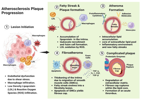 Focused Ultrasound, an Emerging Tool for Atherosclerosis Treatment: A ...