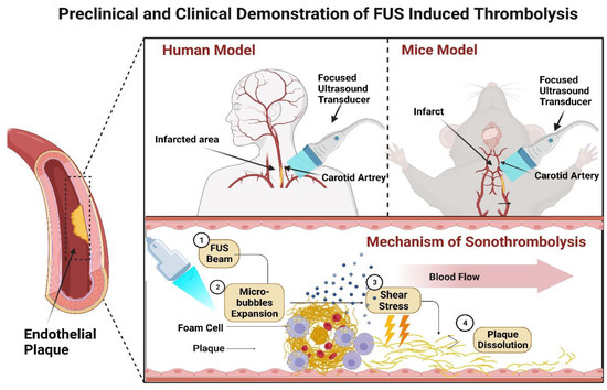 Focused Ultrasound, an Emerging Tool for Atherosclerosis Treatment: A ...