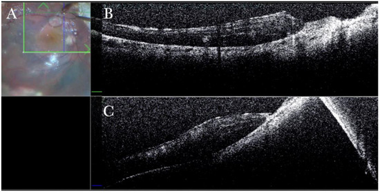 The Role of the Intraoperative Optical Coherence Tomography for ...
