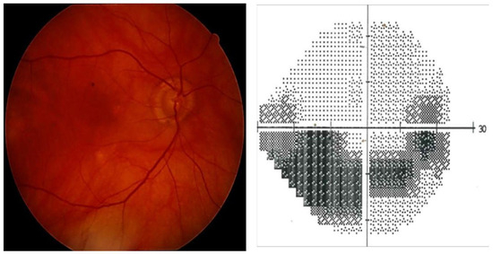 Bilateral Angle Recession and Chronic Post-Traumatic Glaucoma: A Review ...