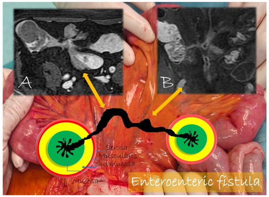 Small Bowel Imaging from Stepchild of Roentgenology to MR Enterography ...