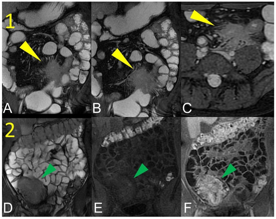 Small Bowel Imaging from Stepchild of Roentgenology to MR Enterography ...