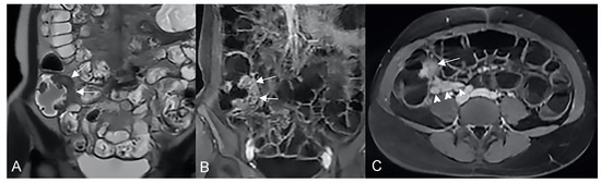 Small Bowel Imaging from Stepchild of Roentgenology to MR Enterography ...