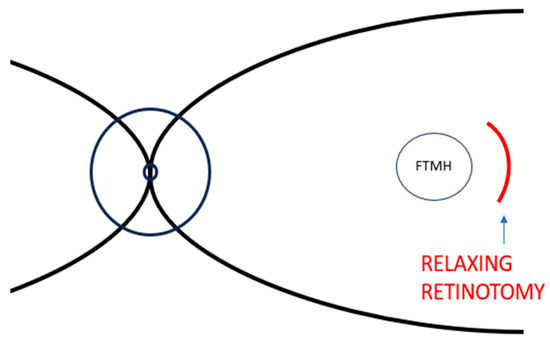 Relaxing Retinotomy in Recurrent and Refractory Full-Thickness Macular ...