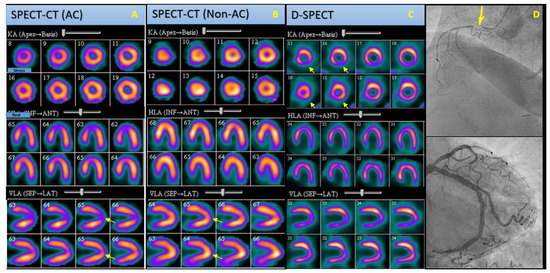 Head-to-Head Comparison of CZT-SPECT and SPECT/CT Myocardial Perfusion Imaging: Interobserver ...