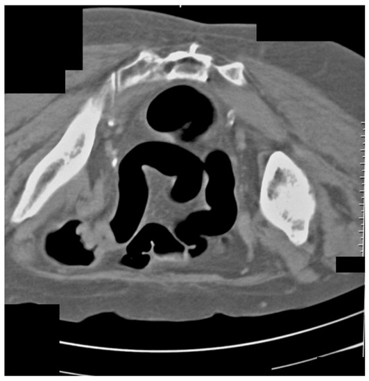 High Concordance of CT Colonography and Colonoscopy Allows for the ...